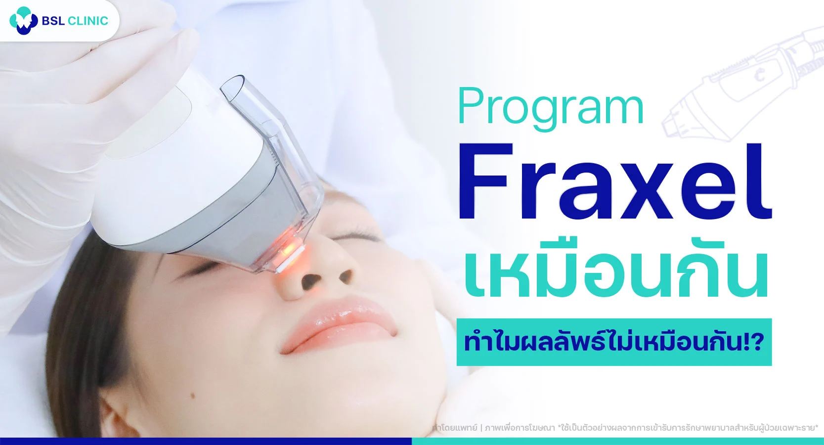ทำ Fraxel Program แล้วผลลัพธ์ต่างกันเพราะมีปัจจัยอะไรบ้าง?